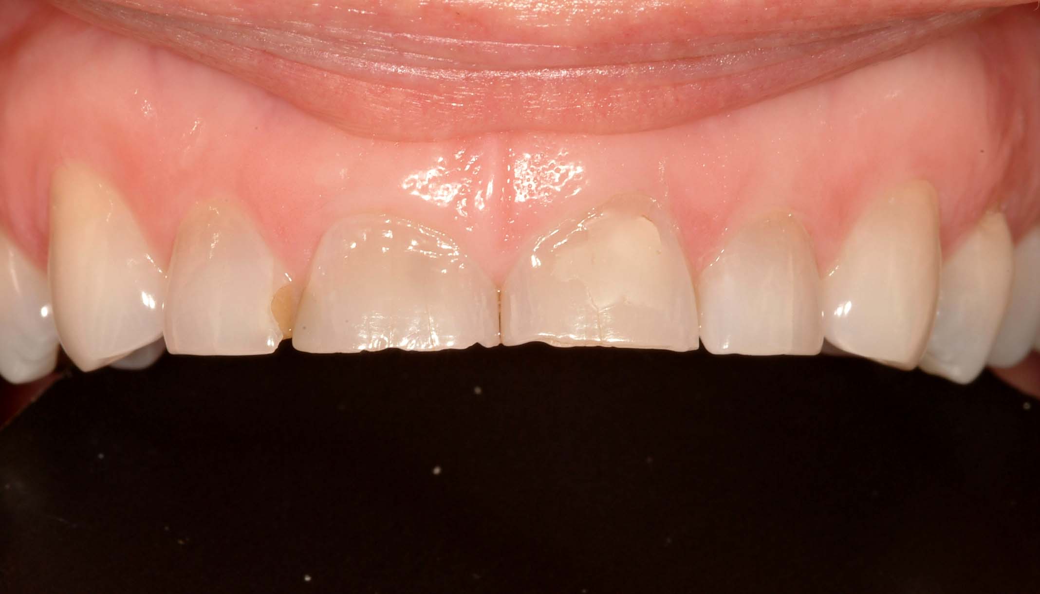 Gum lift and Crown lengthening | Institute of Dental Implants ...
