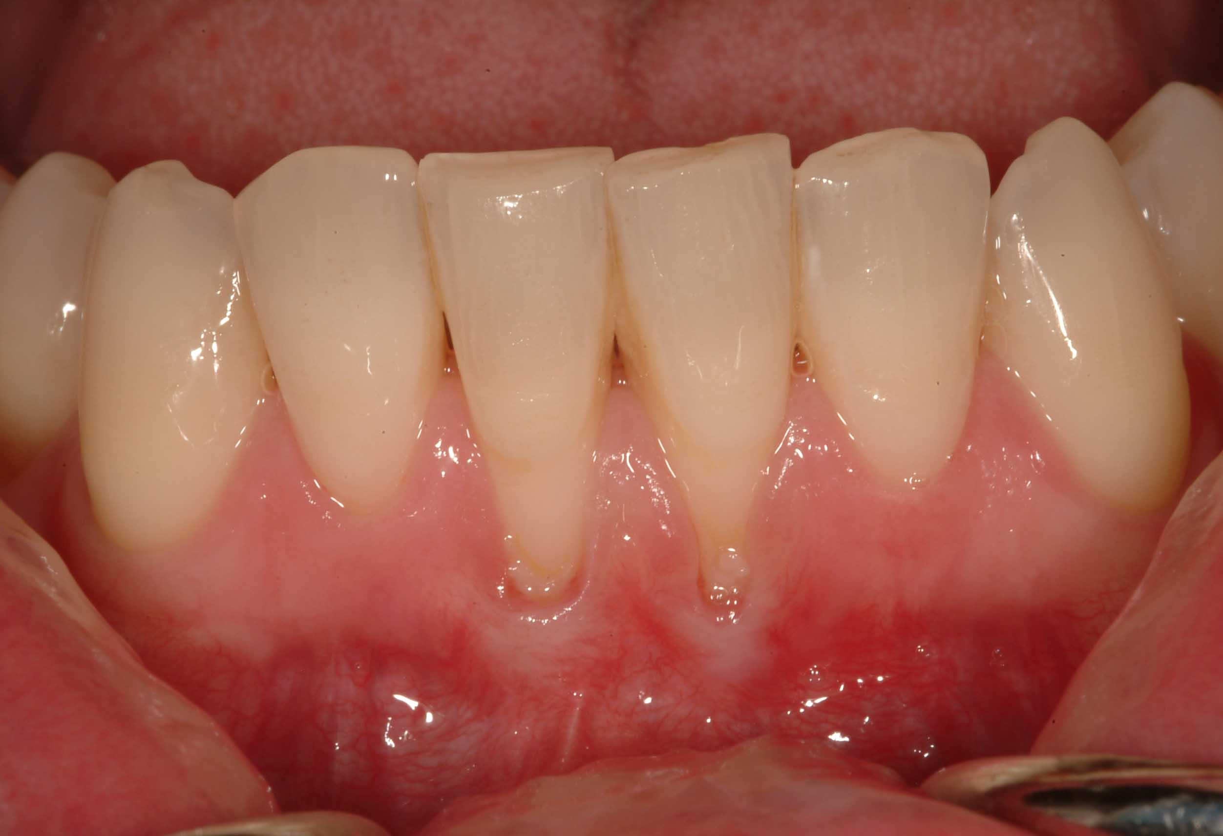 Gum regeneration | Institute of Dental Implants & Periodontics
