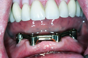 Bar Retained Over Denture | Institute of Dental Implants & Periodontics