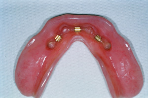 Bar Retained Over Denture | Institute of Dental Implants & Periodontics