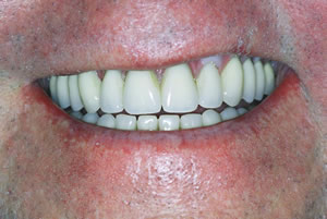 Bar Retained Over Denture | Institute of Dental Implants & Periodontics