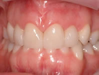 Smile Makeover | Institute of Dental Implants & Periodontics