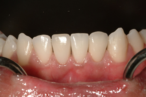 Single Tooth Implants | Institute of Dental Implants & Periodontics