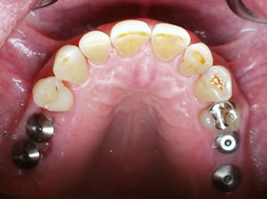 Molar Implants | Institute of Dental Implants & Periodontics