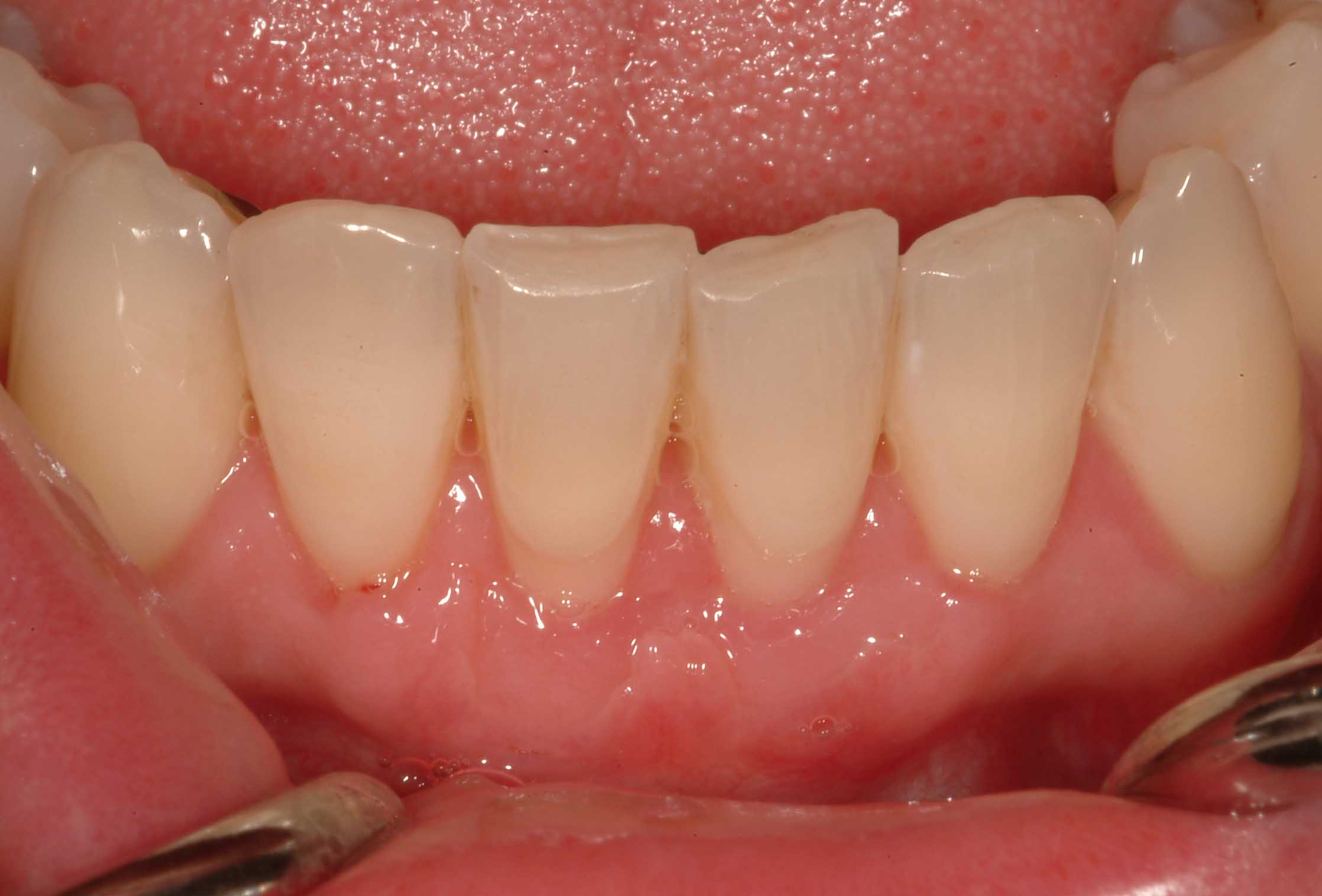 Gum regeneration | Institute of Dental Implants & Periodontics